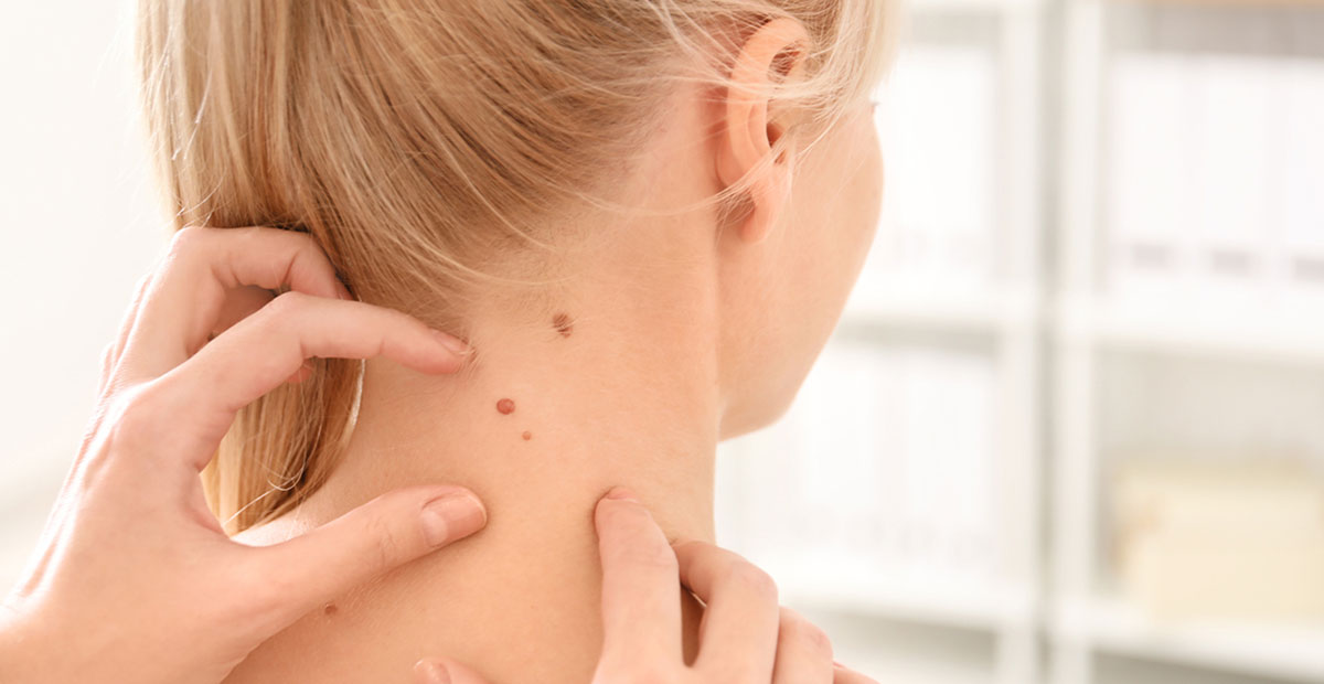 Skin Tag Removal Treatment in Jubilee Hills Hyderabad | Skin Bliss Clinic