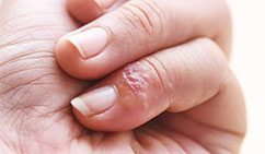 Skin Allergy & skin Infection Treatment clinic in Hyderabad