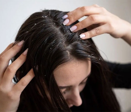 Dadruff Treatment in Hyderabad at Skinbliss Clinic